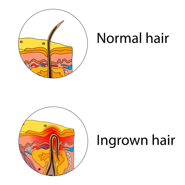 Everything You Need to Know About Ingrown Hairs - LIFESTYLE BY PS